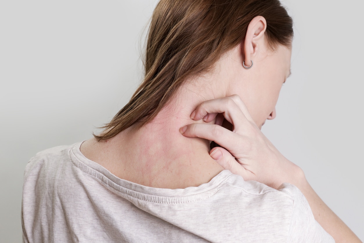 Prickly heat (heat rash)- Causes, home remedies and preventions
