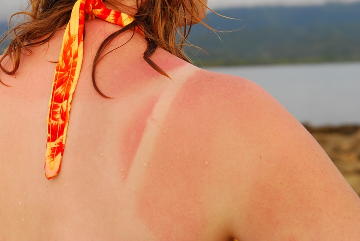 Best home remedies to get rid of sunburn | Watsons Singapore