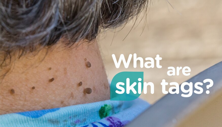 What are skin tags & How to get rid of them? | Watsons Singapore
