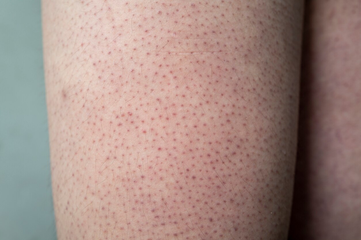 Strawberry Legs Causes And How To Get Rid Of Them Watsons Singapore Strawberry Legs Causes And How To Get Rid Of Them Watsons Singapore